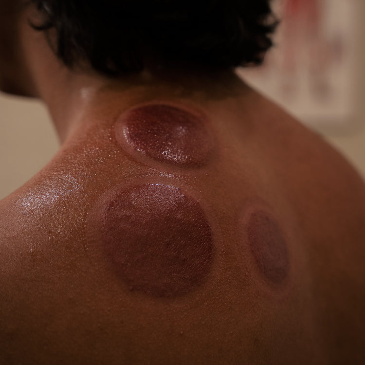 The Benefits of Cupping Therapy: A Natural Path to Wellness and Balanc ...